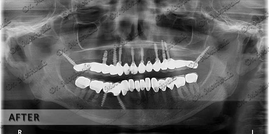 One Piece Implants excellent