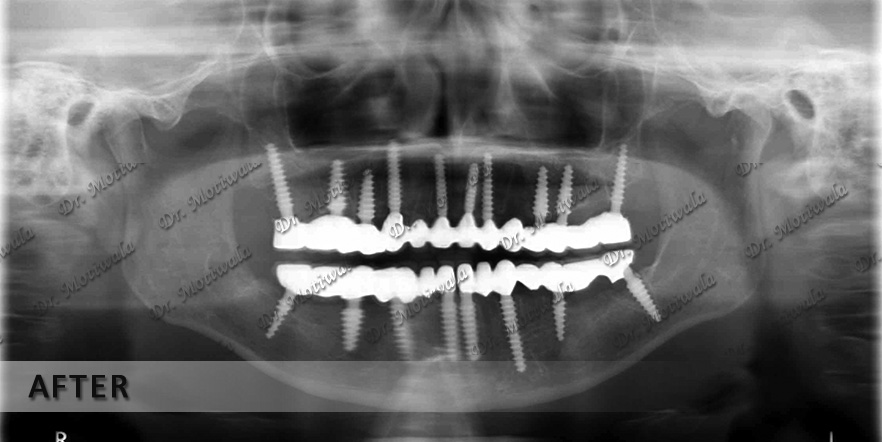 Basal Implants and Basal Screws