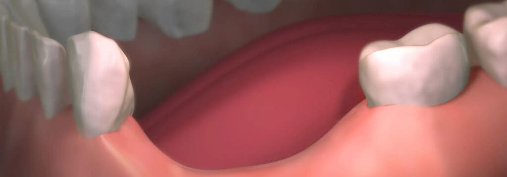 Ways to Prevent Bone Loss after Tooth Extraction - The Sinus Lift