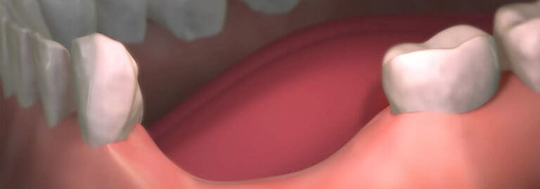 Ways to Prevent Bone Loss after Tooth Extraction - The Sinus Lift