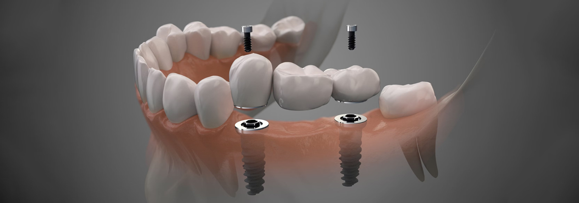 Digital Dentistry: Guided Implant Placement | Best Dental Clinic in ...