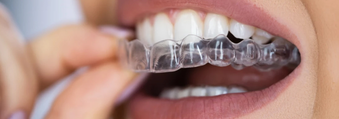 Invisalign & Beyond: Transforming Smiles with Orthodontics | Best ...