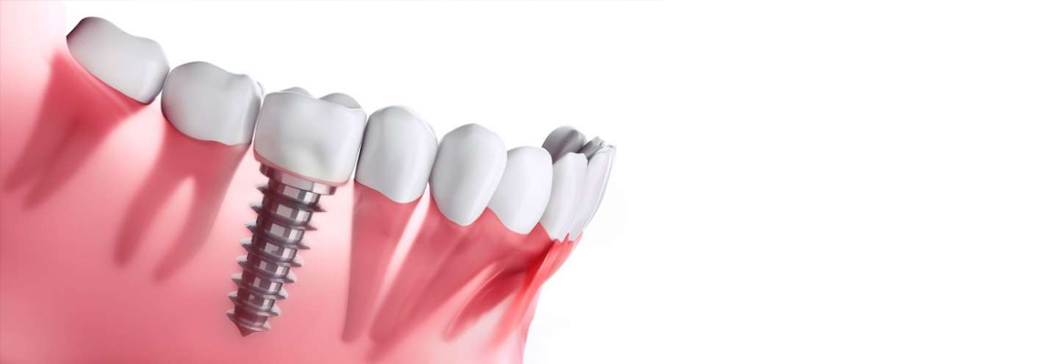 The Evolution of Dental Implants: A Journey Through Time | Best Dental ...
