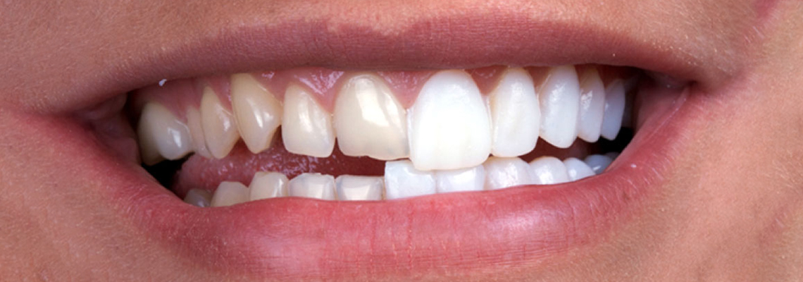 How to Spot a Bad Smile Makeover: Red Flags to Watch Out For | Best ...